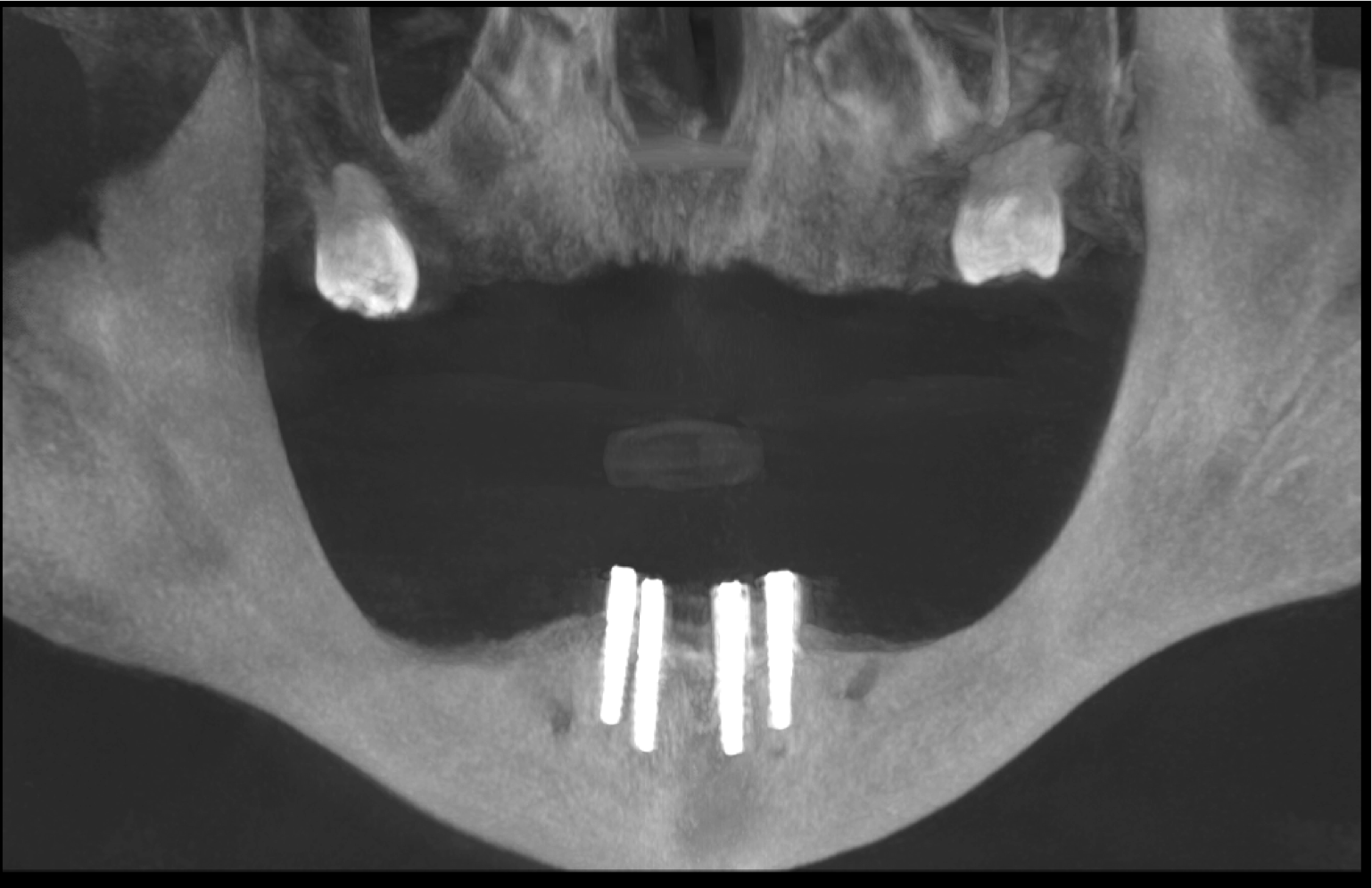 URQ Lateral Window Sinus Augmentation with PRF and Implant Placement at ...
