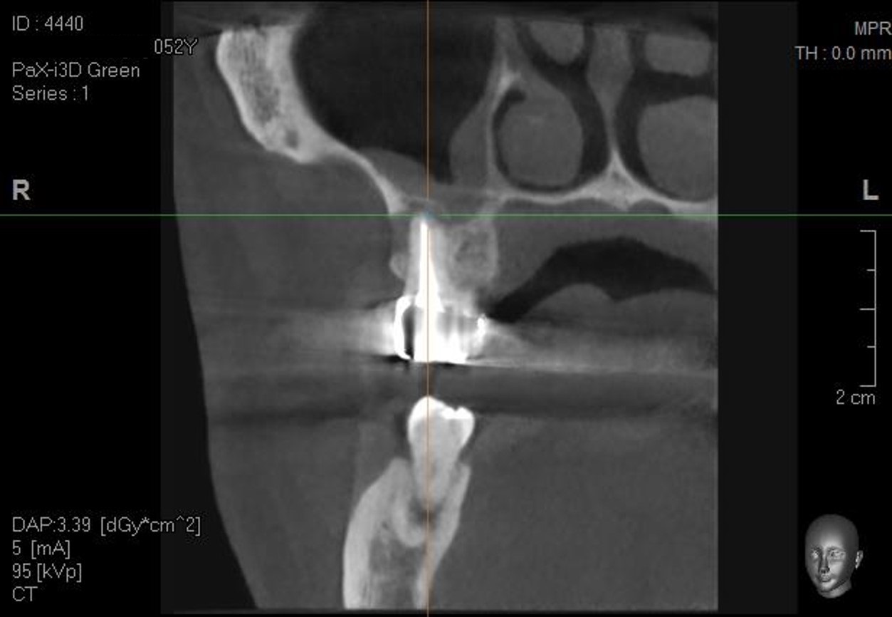 Sinus Pathology Imaging - GreenCT